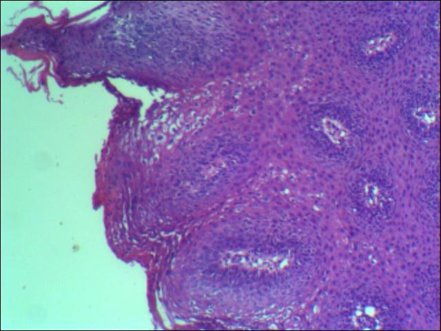 CIN1 – კოილოციტური ჰიპერპლაზია. - PathologyOnline - შემთხვევები